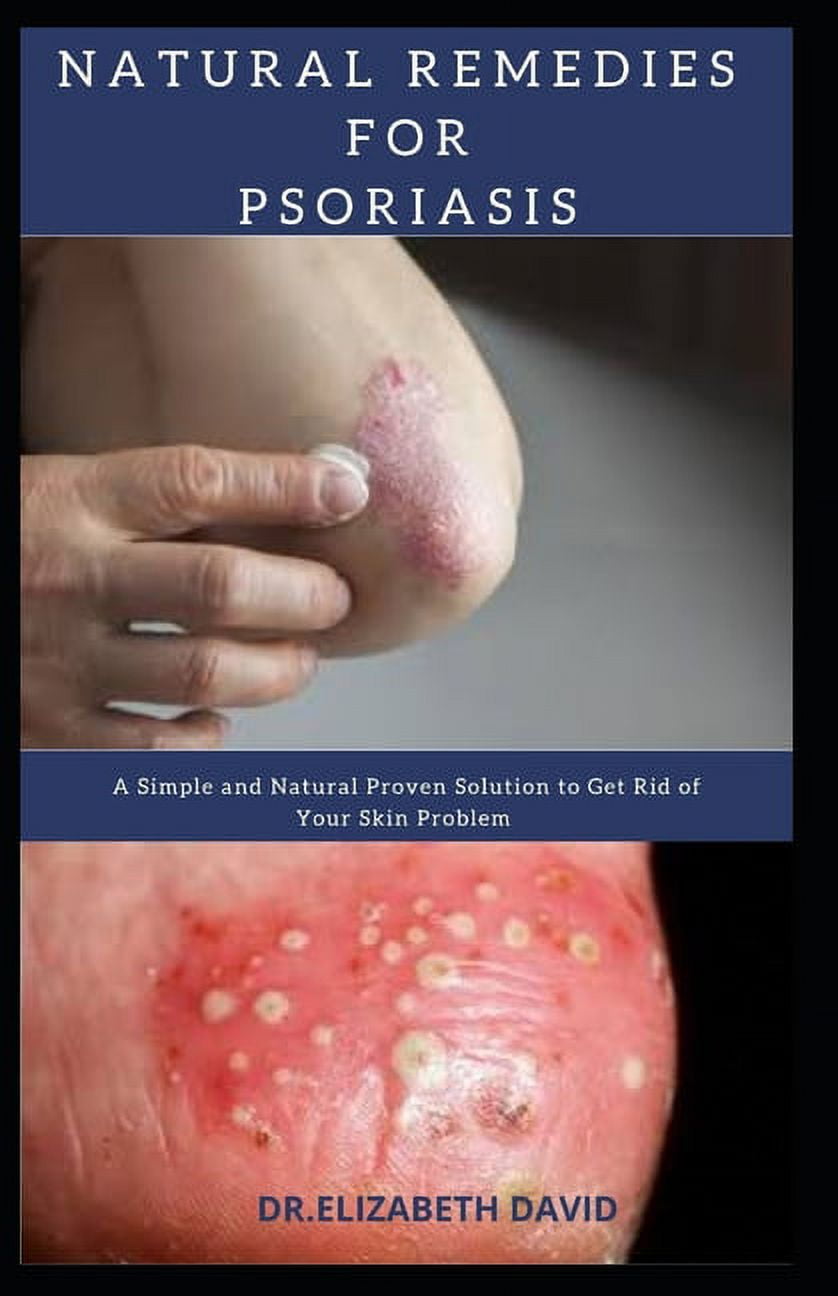 Natural Remedies for Psoriasis: A Simple and Natural Proven Solution to Get Rid of Your Skin ...
