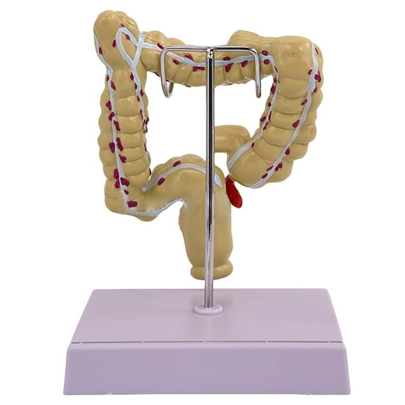 Necvior Large Intestine Pathologies Model Human Large Intestine Model ...