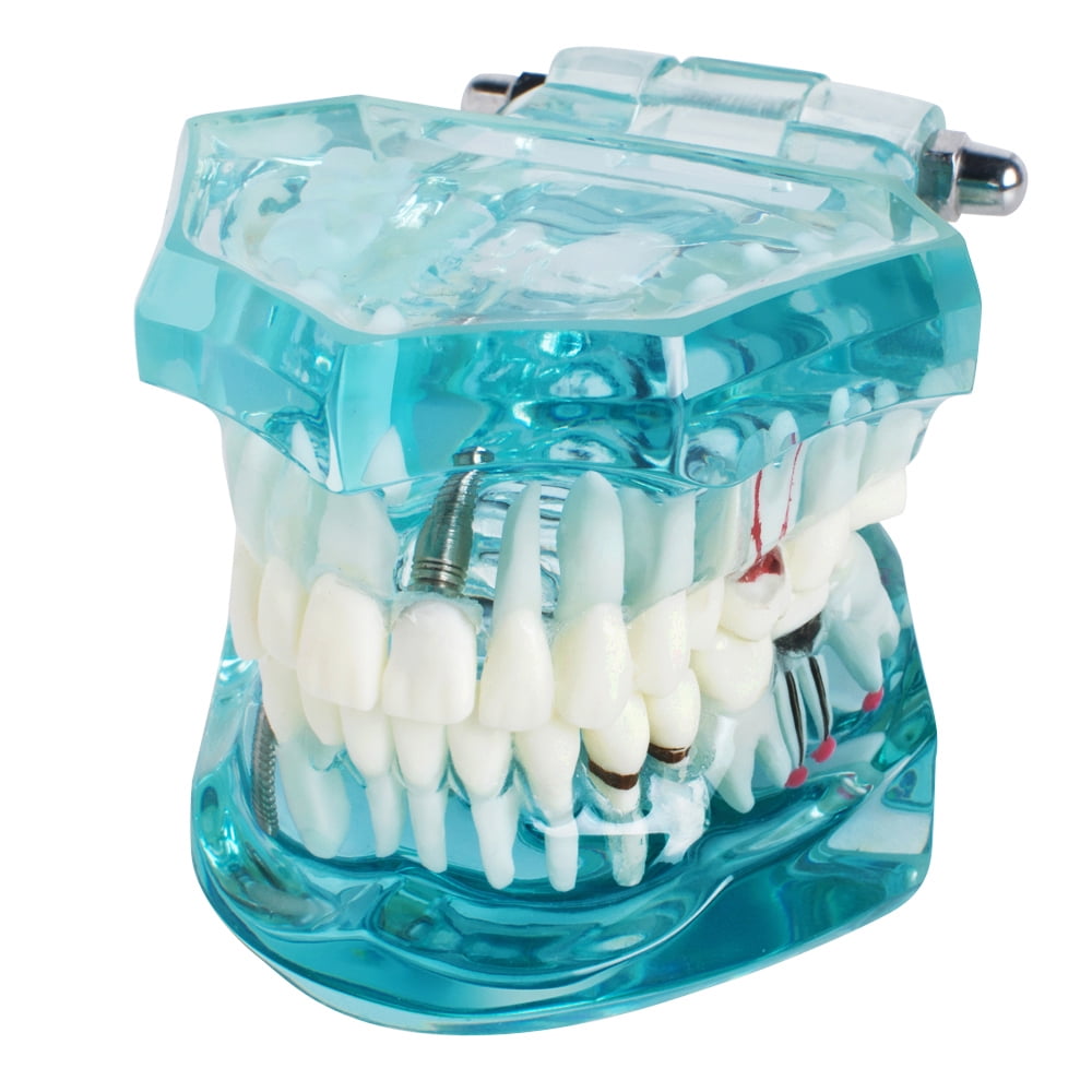 New Dental Study Tooth Transparent Adult Pathological Teeth Model ...