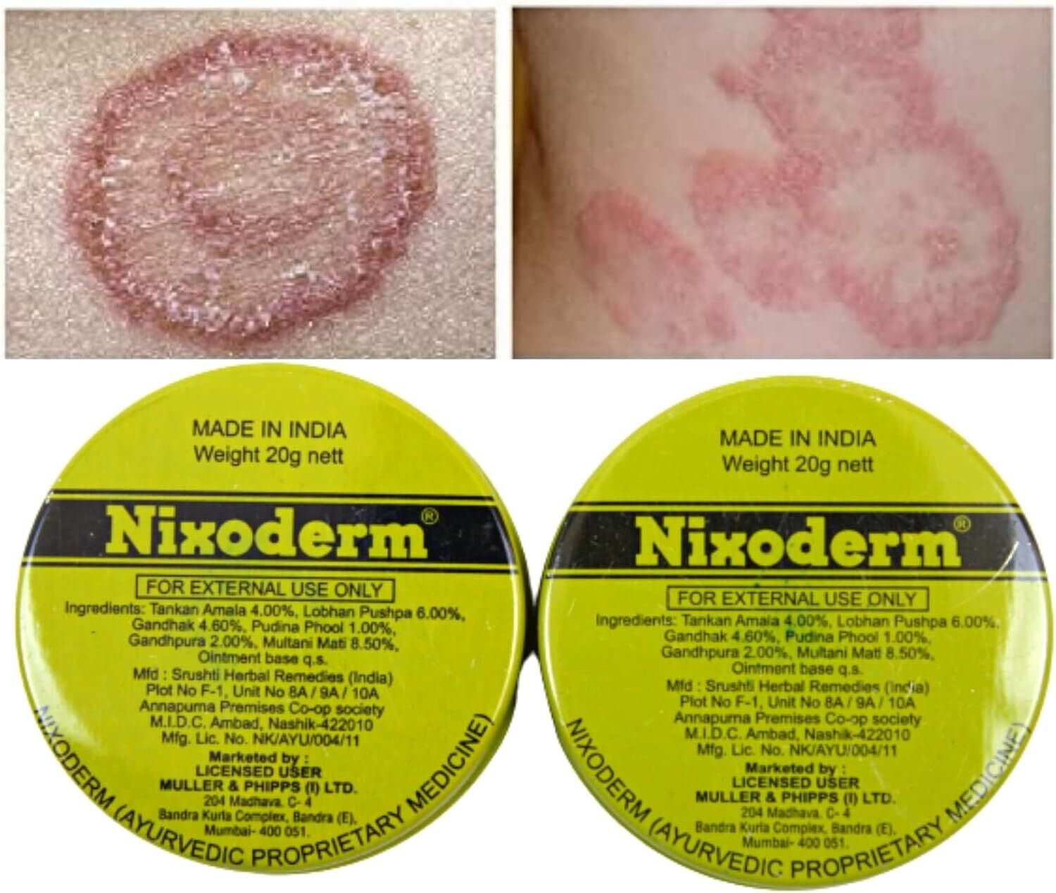 Nixoderm Cream for Pimples, Blemishes, Rash, Foot, Ringworm, Scaling ...