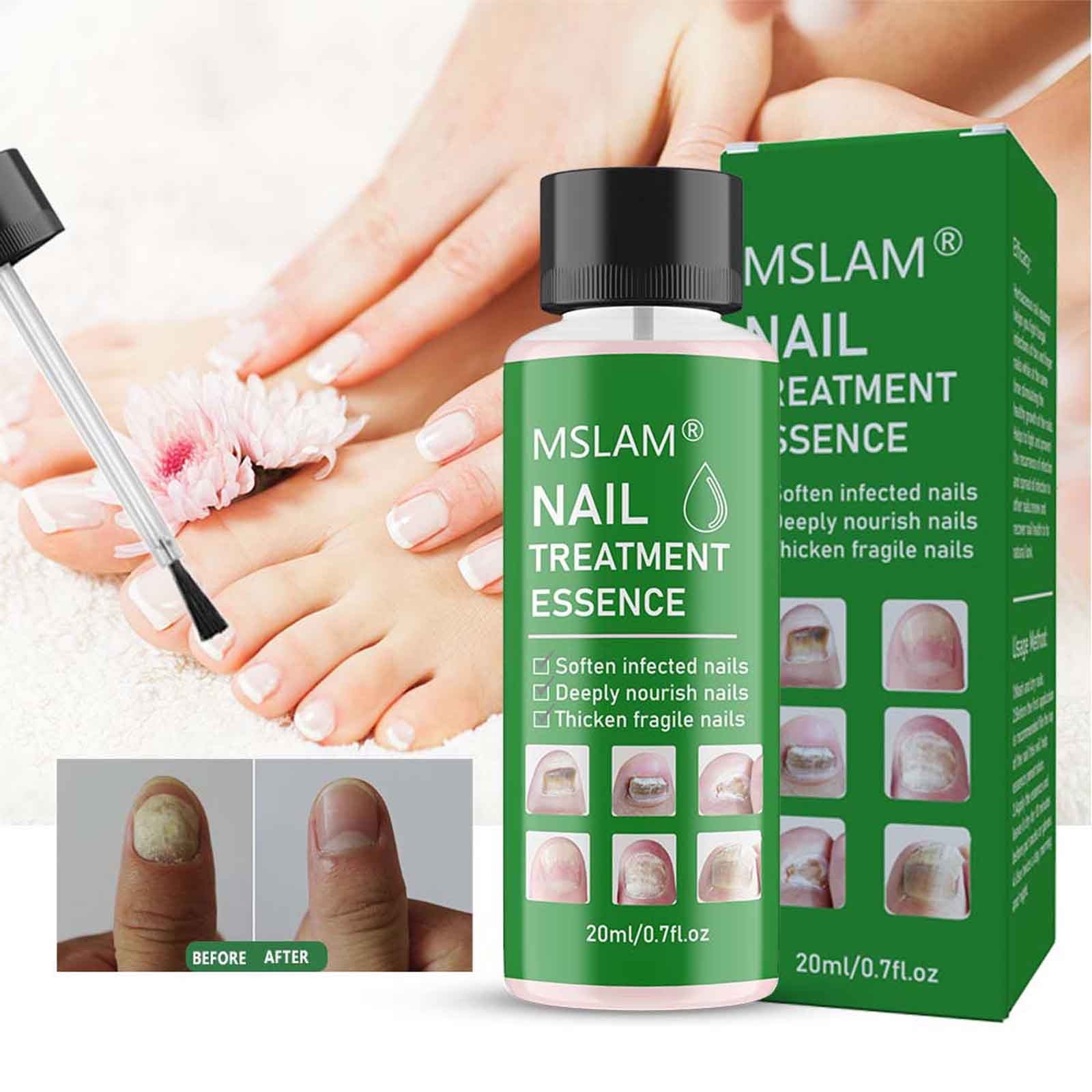 Njagoc Antibacteria Liquid Of Ash Nail Herbal Ash Nail Care Liquid Ash ...