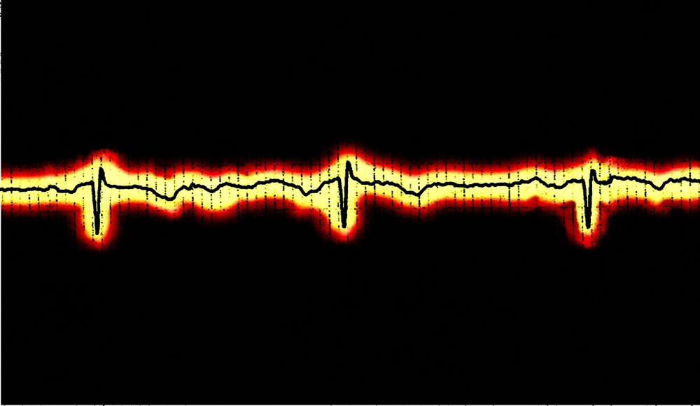 Normal ECG Poster Print by Science Source (36 x 24) - Walmart.com