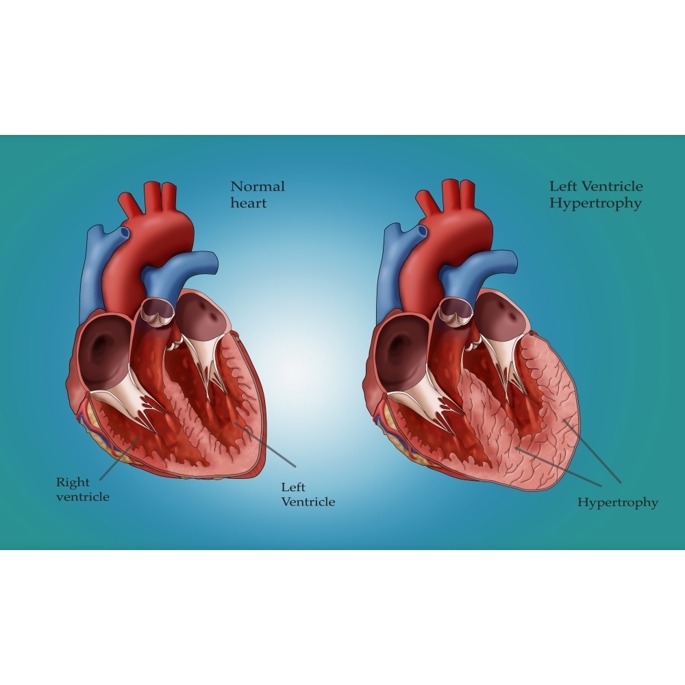 Normal Heart vs. Left Ventricle Hypertrophy Poster Print by Monica ...