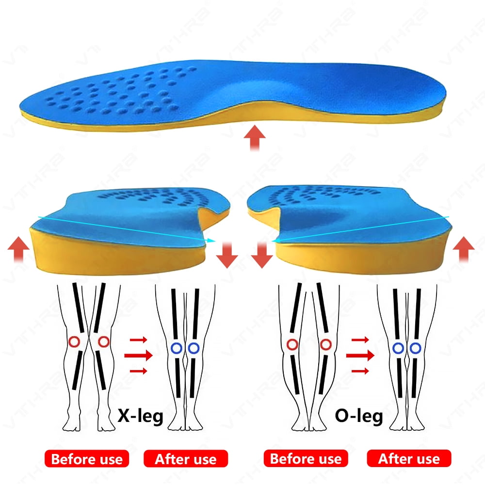 O/X Leg Orthopedic Insoles Correction Shoes Inserts For Foot Alignment ...