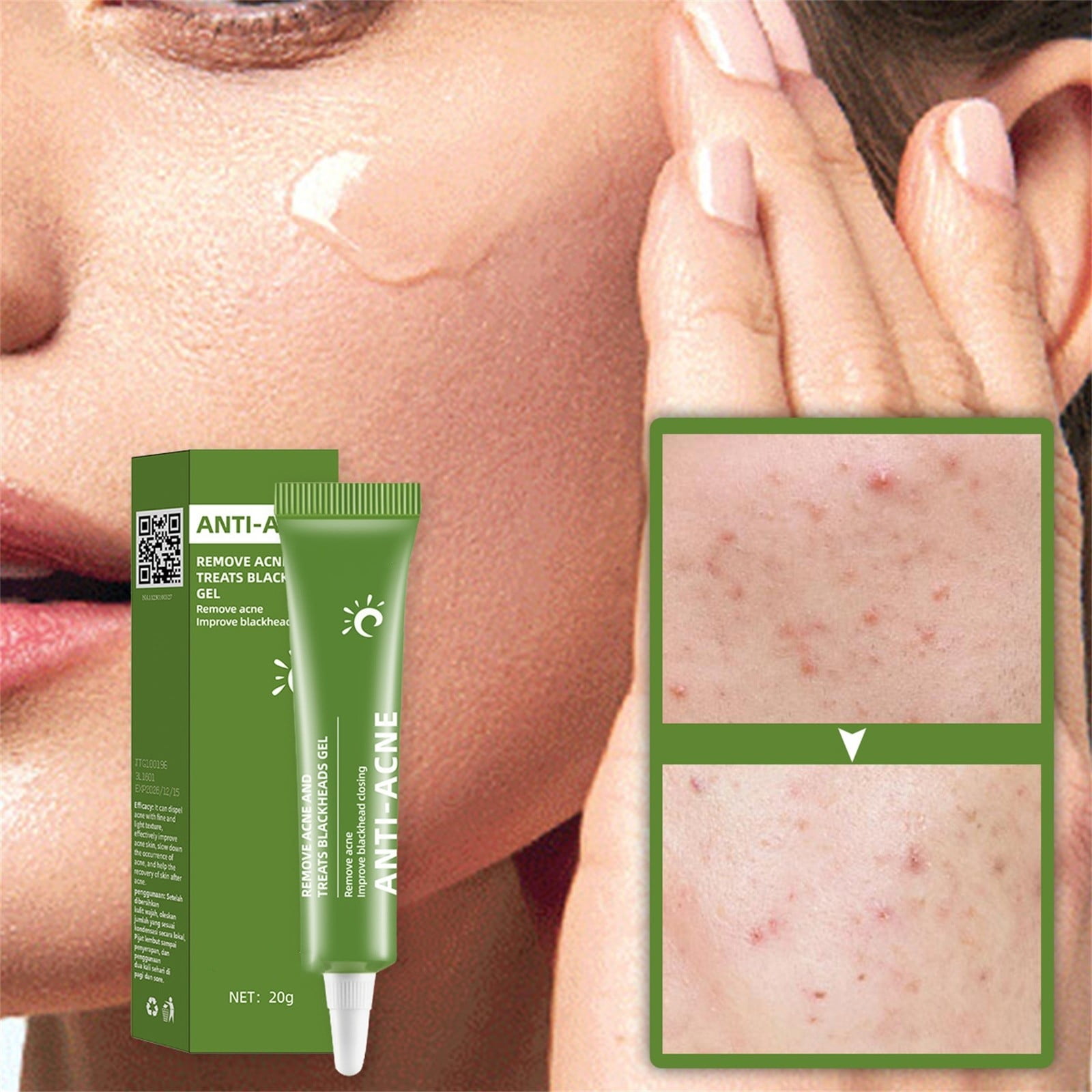 On-The-Spot Acne Treatment Gel with Benzoyl Peroxide - Gentle Face Acne ...