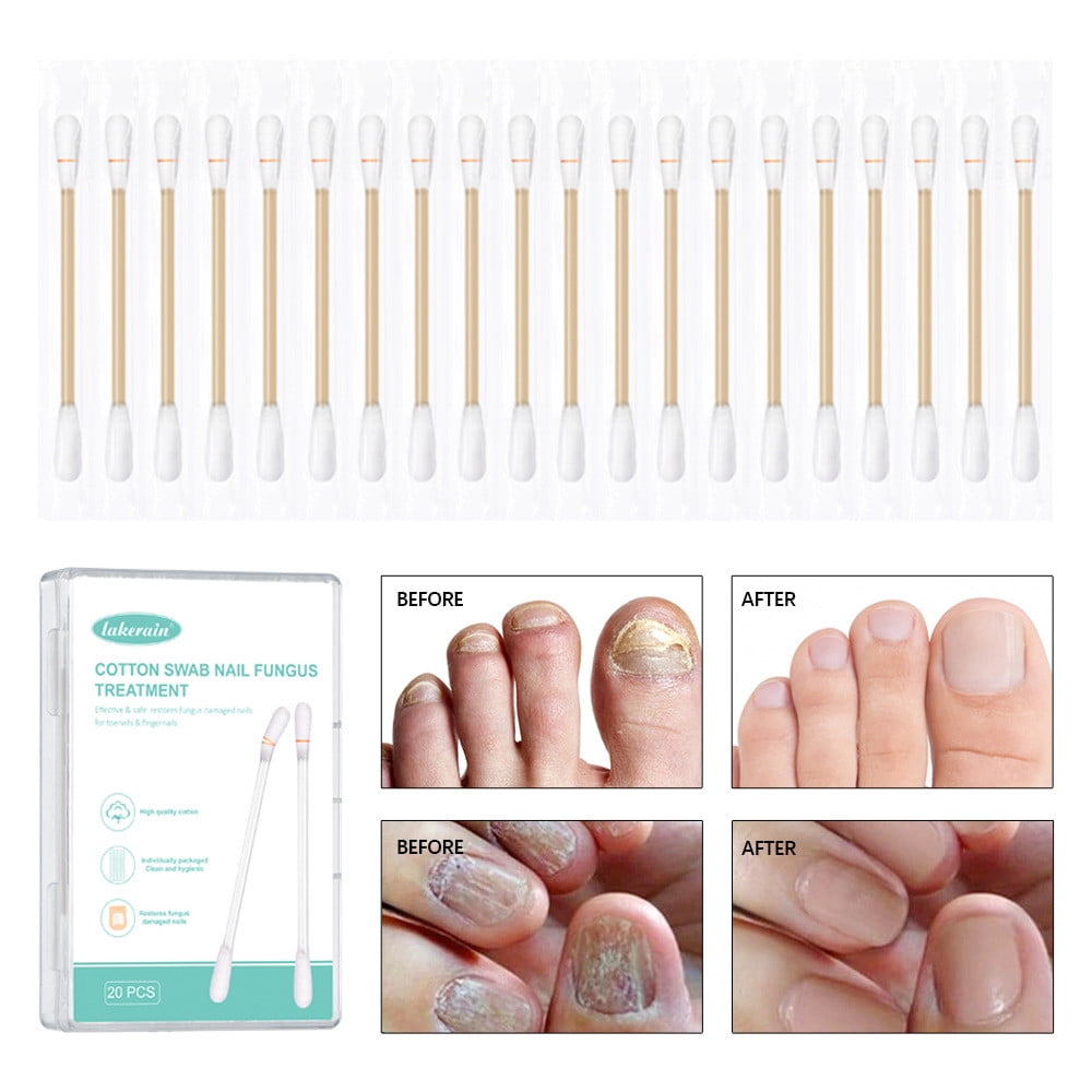 Openpig Clearance Toenailplus-Anti Paronychia Relief Oil, Paronychia ...