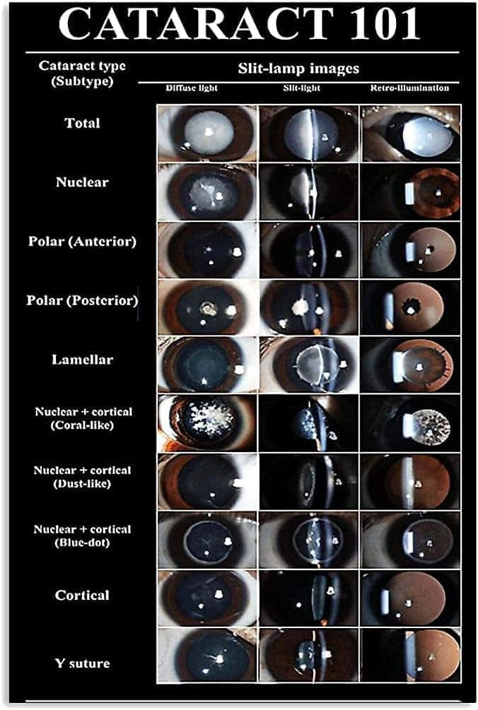 Ophthalmology Tin Poster Cataract 101 Guide Metal Signs Vintage ...