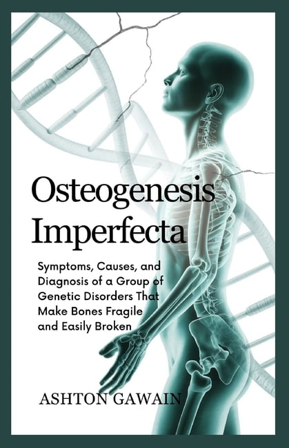 Osteogenesis Imperfecta: Symptoms, Causes, and Diagnosis of a Group of ...