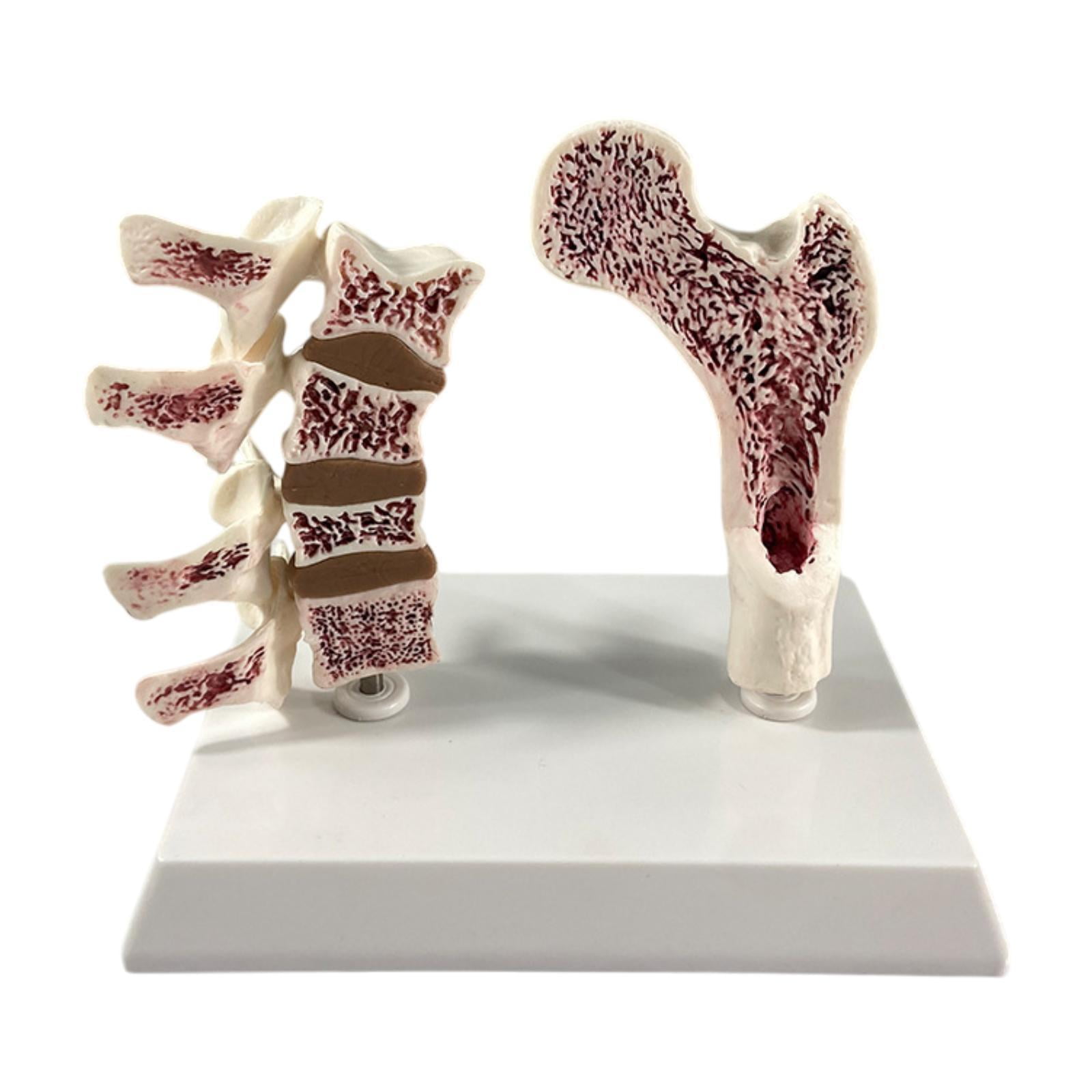 PETSOLA Human Femur Osteoporosis Model Painted Sturdy Portable Resuable ...