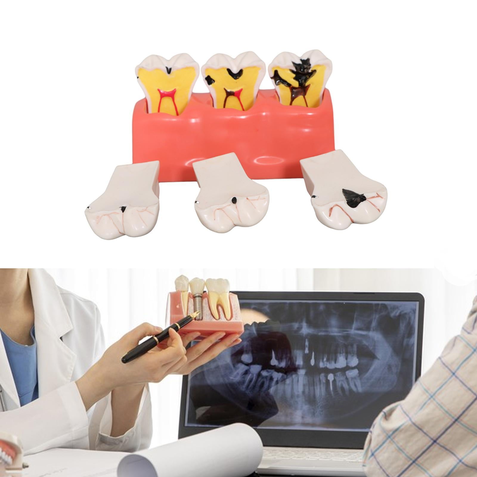 PETSOLA Sumulation Decay Tooth Model Demonstration Removable 4 Times ...