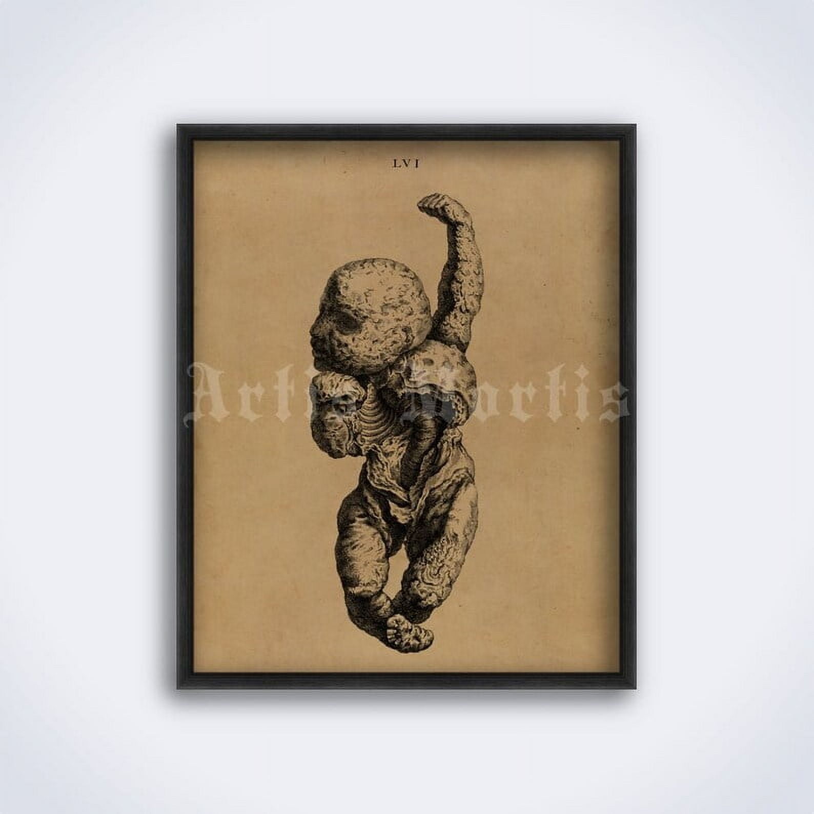 POSTER Anomaly fetus skeleton, stone baby - anatomy, pathology, oddity ...
