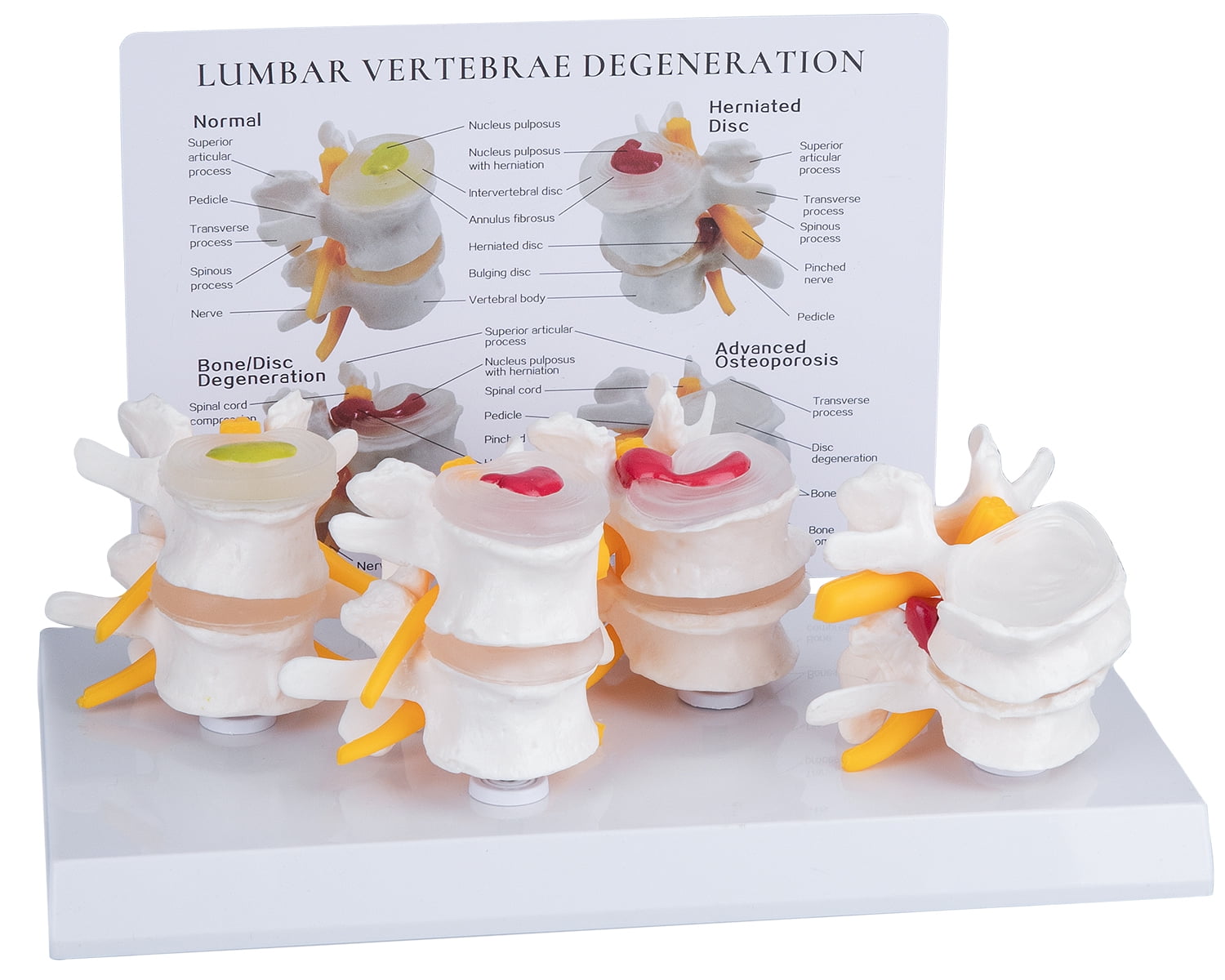 Pathological Human Lumbar Spine Anatomy Model 4-Stage Medical Science ...