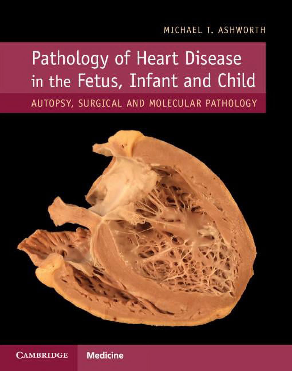 Pathology of Heart Disease in the Fetus, Infant and Child: Autopsy ...