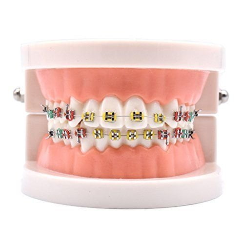 Patient Education Model With Orthodontic Brackets MD-119 - Walmart.com