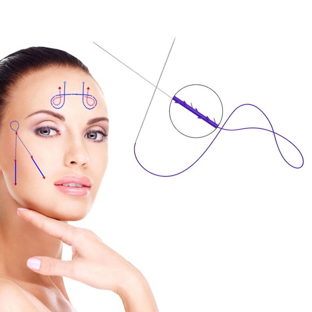 Pdo Thread For Face Lift/Whole Body LiftBidirectional Cog Thread/Pdo ...