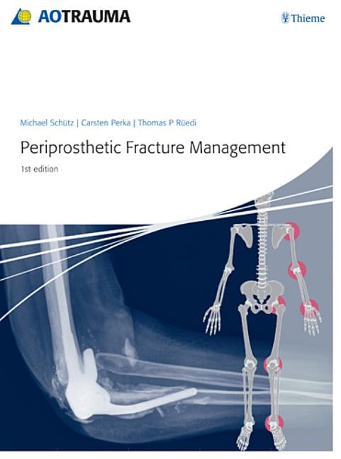 Periprosthetic Fracture Management, (Hardcover) - Walmart.com