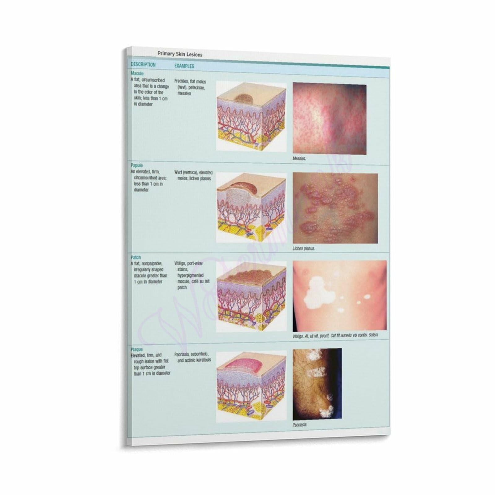 Primary Skin Lesions Dermatology Posters Canvas Painting Wall Art ...