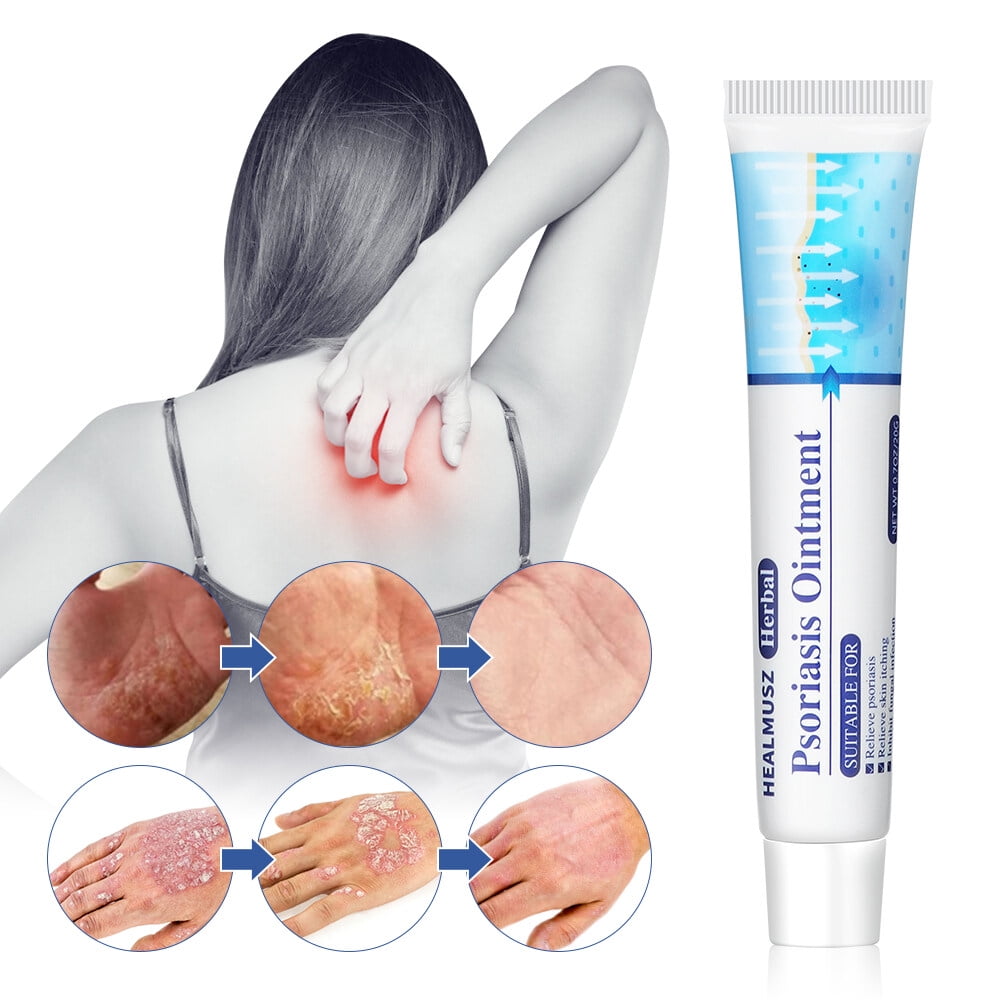 Psoriasis Antibacterial Ointment Eczema Pruritus Treatment Skin Rash