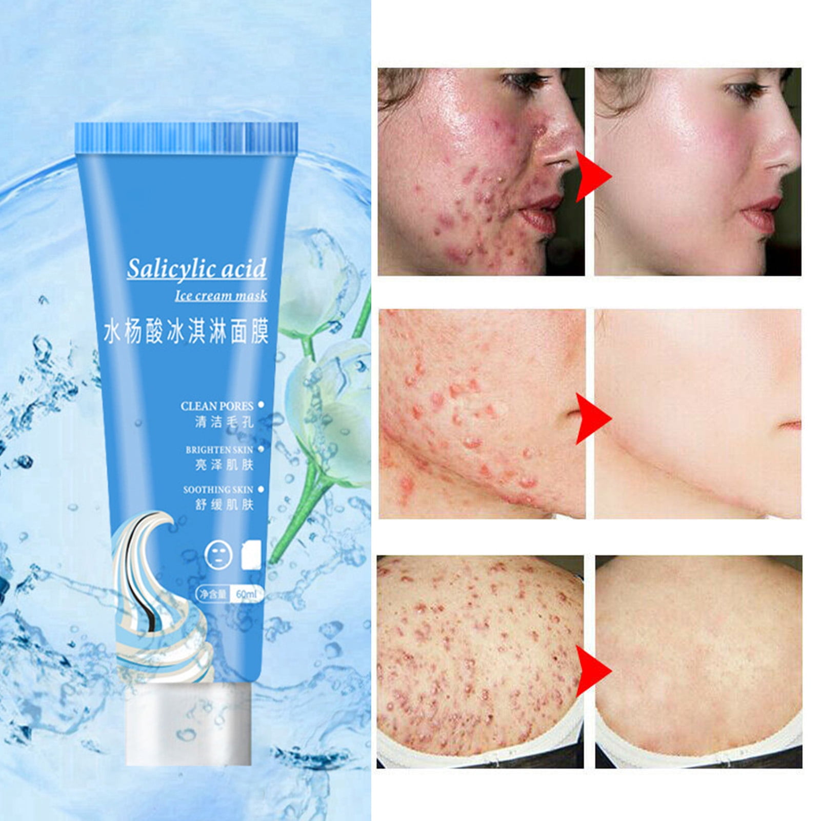 RAOx Salicylic Acid Acne Scars Blackhead Removal Hydrating Moisture ...