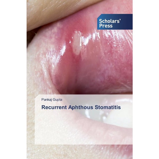 Recurrent Aphthous Stomatitis (Paperback) - Walmart.com