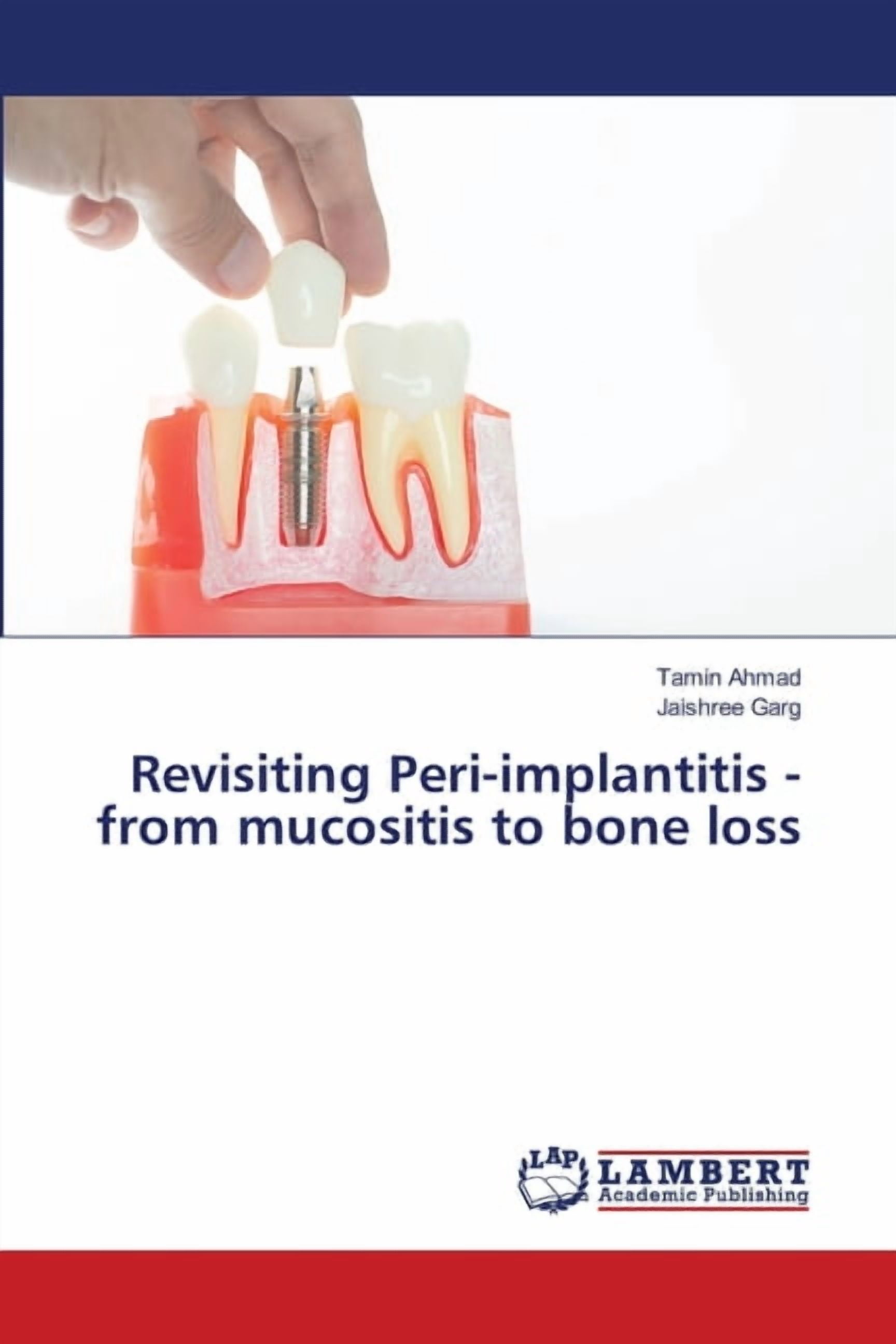 Revisiting Peri-implantitis - from mucositis to bone loss, (Paperback ...