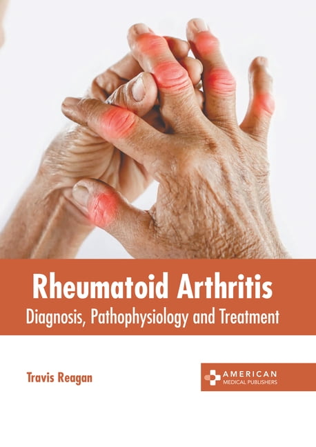 Rheumatoid Arthritis: Diagnosis, Pathophysiology and Treatment ...
