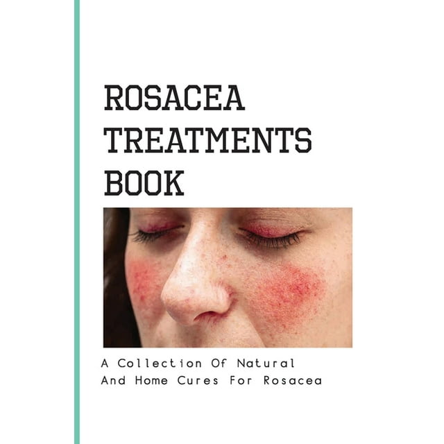 Rosacea Treatments Book- A Collection Of Natural And Home Cures For ...