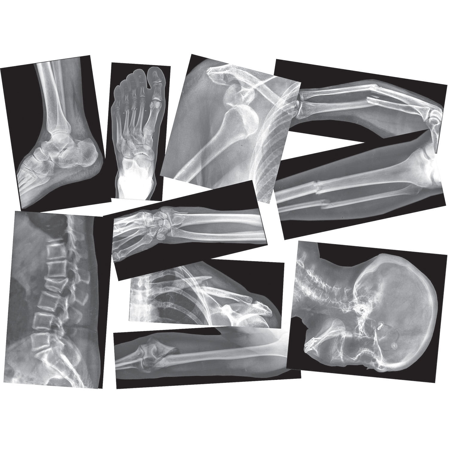 Roylco, RYLR5914, Broken Bones x-rays Set, 15 / Box - Walmart.com