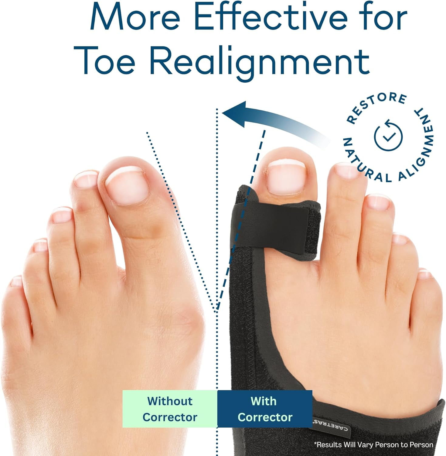 SNYMW Orthopedic Bunion Splint, Pain Relief, Hallux Valgus Correction ...