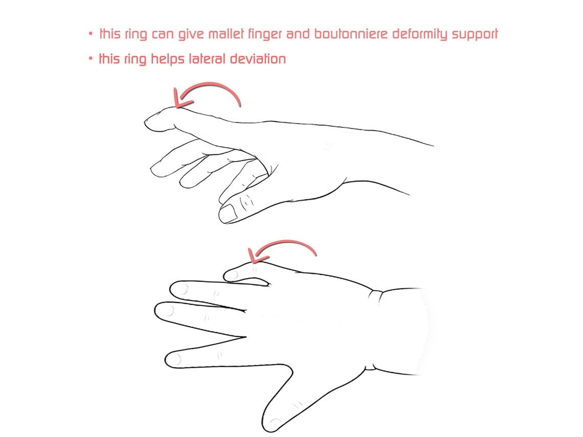 SS DESIGNS Pinky Finger Splint Adjustable Mallet Finger Brace with ...