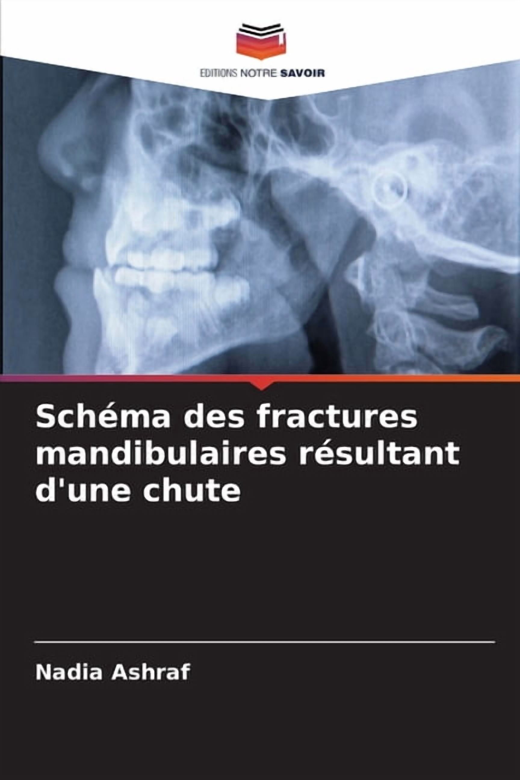 Schéma des fractures mandibulaires résultant d'une chute, (Paperback ...