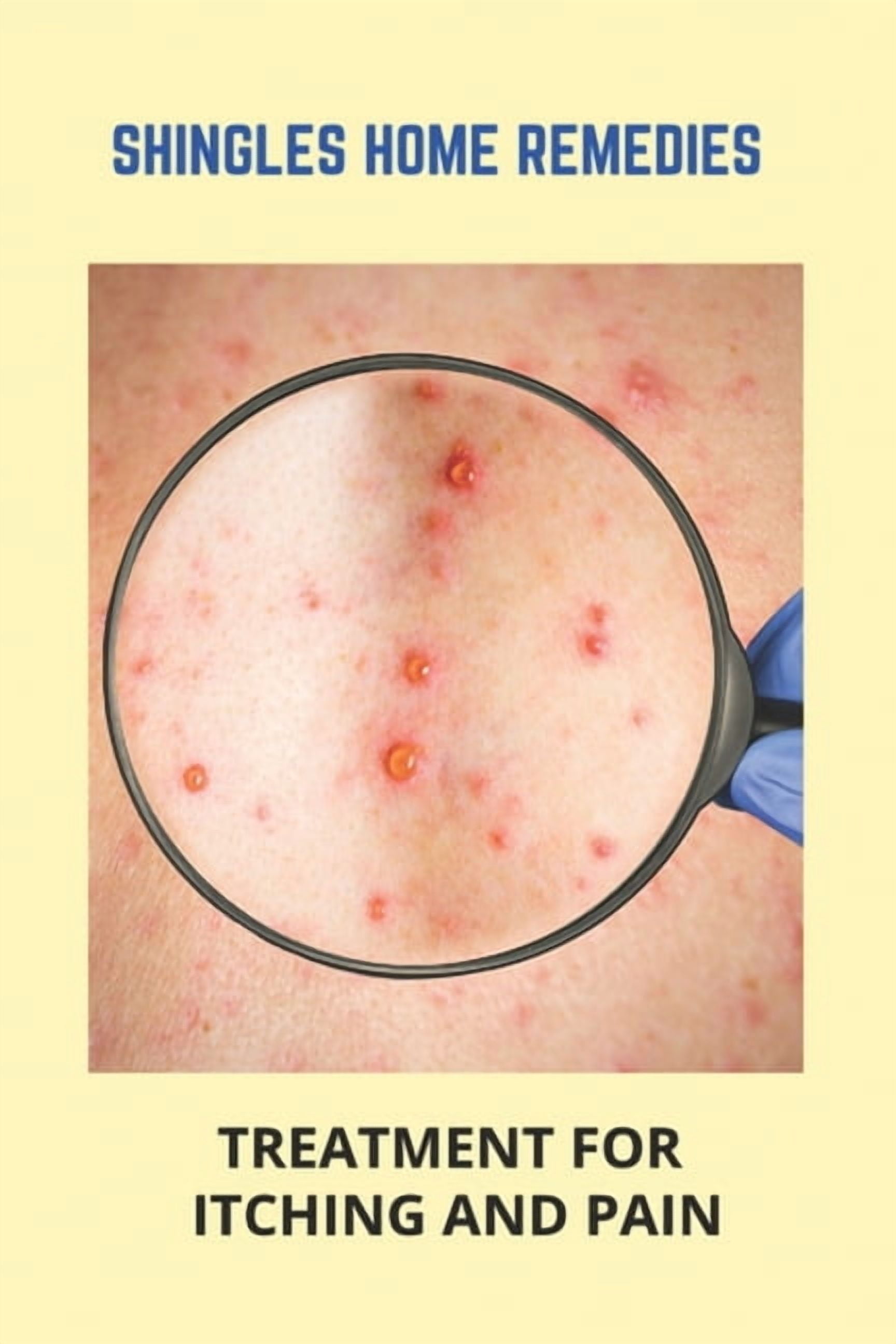 Shingles Home Remedies: Treatment For Itching And Pain: Shingles ...