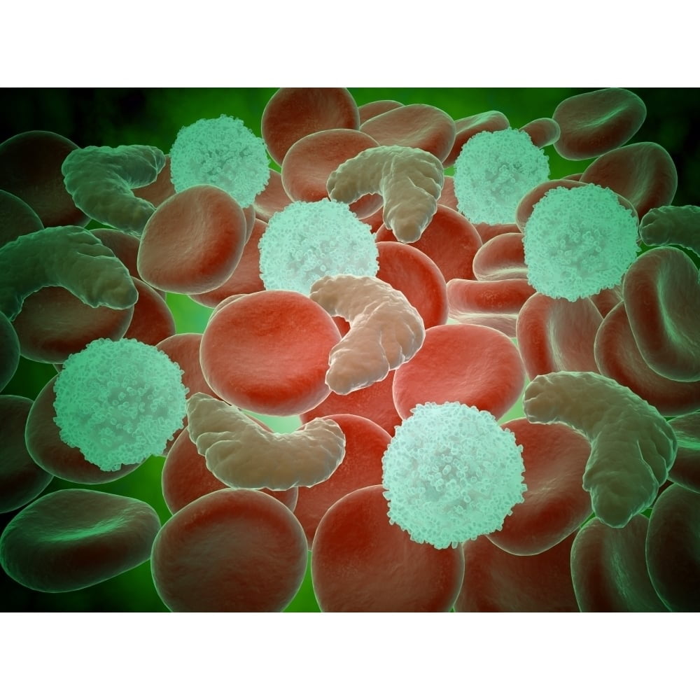Sickle cell anemia with red blood cells and white bood cells Poster ...