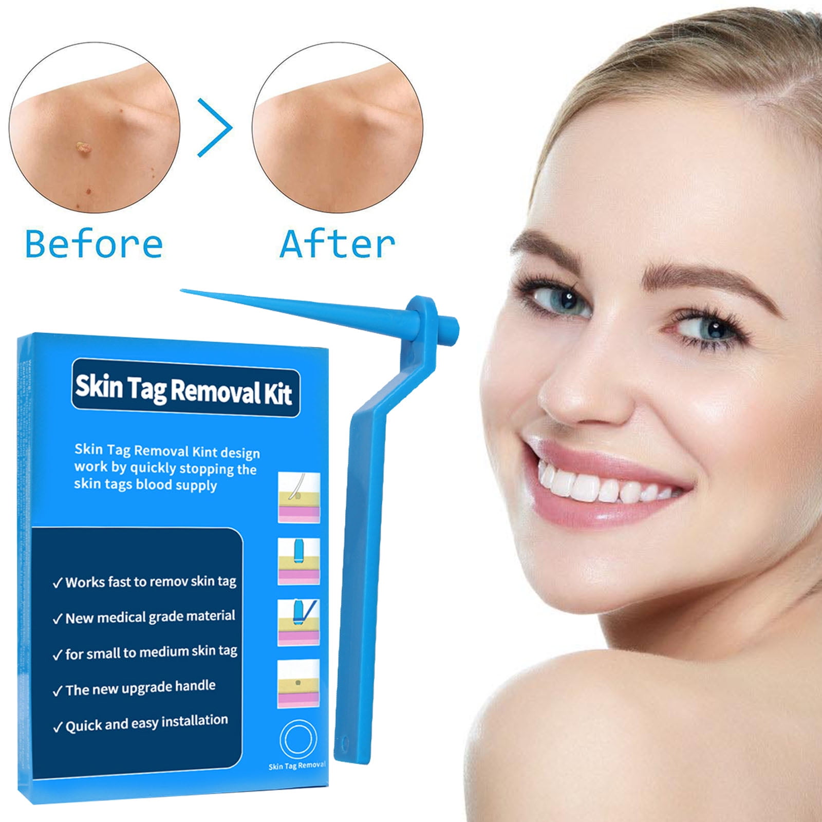 Siquannnn Skin Tag Remover Universal Tag Removing Tool Skin Care For ...
