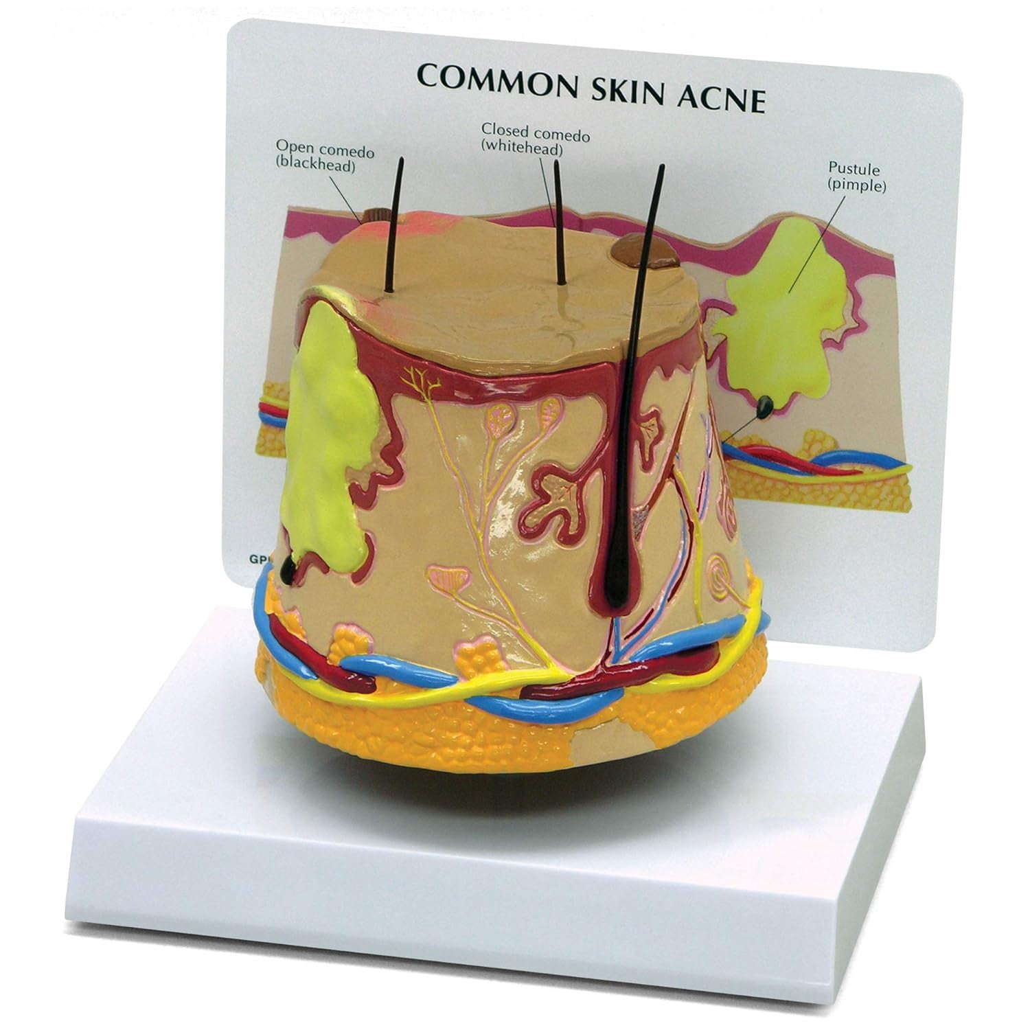 Skin Acne Model, Cylindrical Model Showing Normal and Common Acne ...
