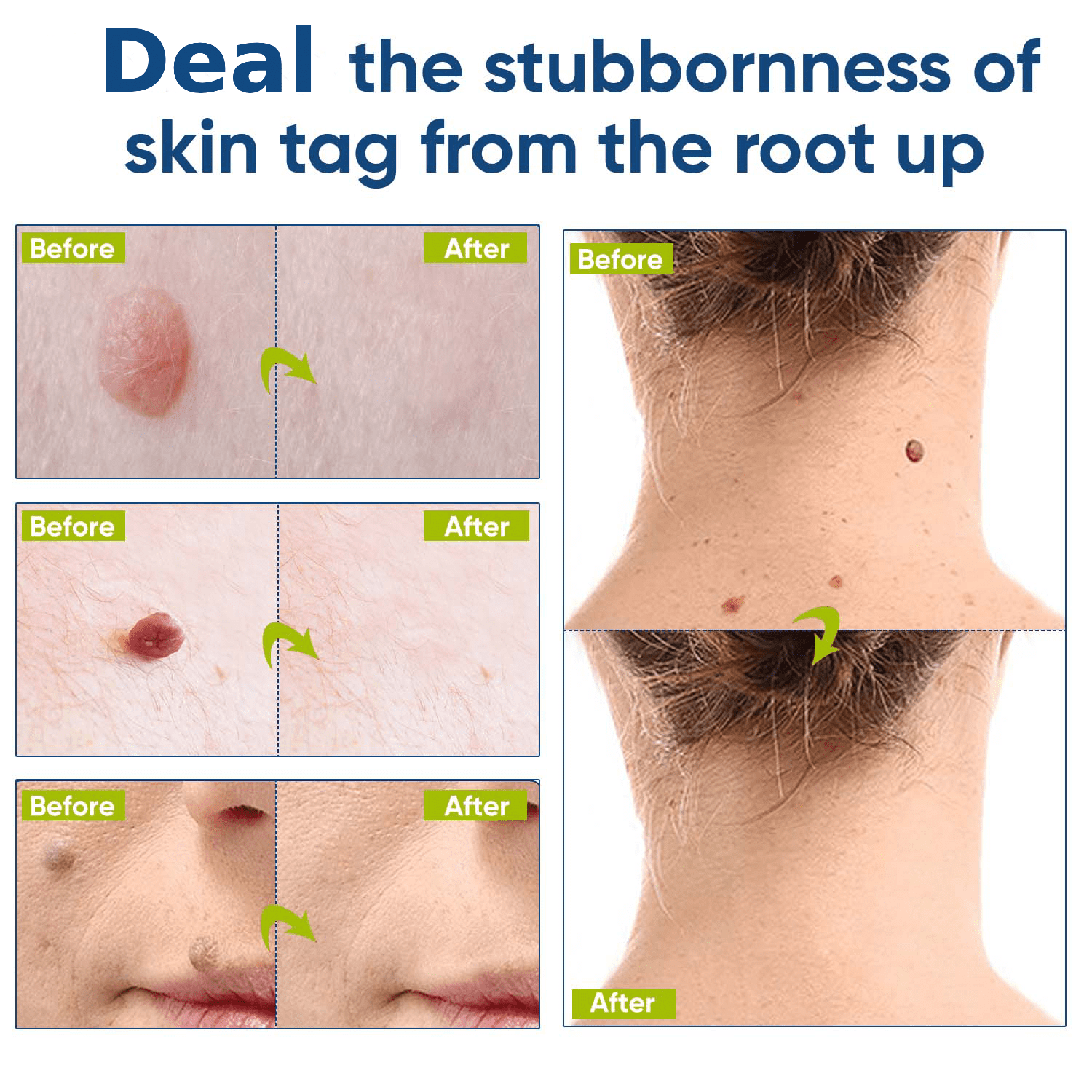 Ta-g Away Fast-Acting Skin-Care Cream, Effective Skin Ta-g Remover ...