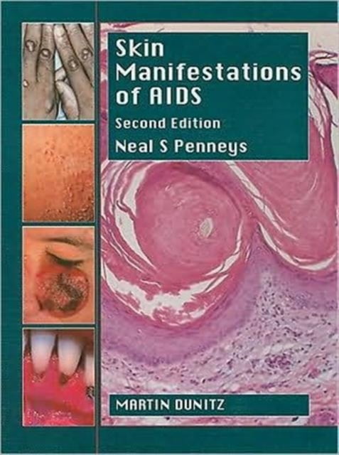 Skin Manifestations of AIDS (Hardcover) by Neal Penneys - Walmart.com