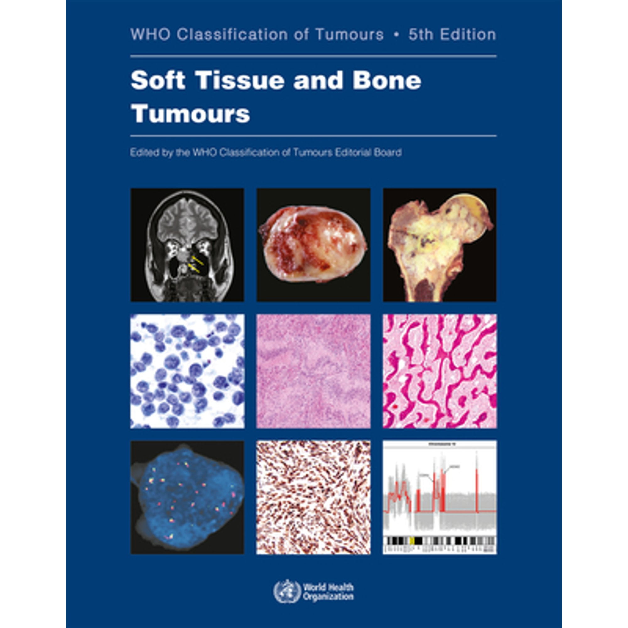 Pre-Owned Soft Tissue and Bone Tumours: Who Classification of Tumours (Paperback 9789283245025 ...