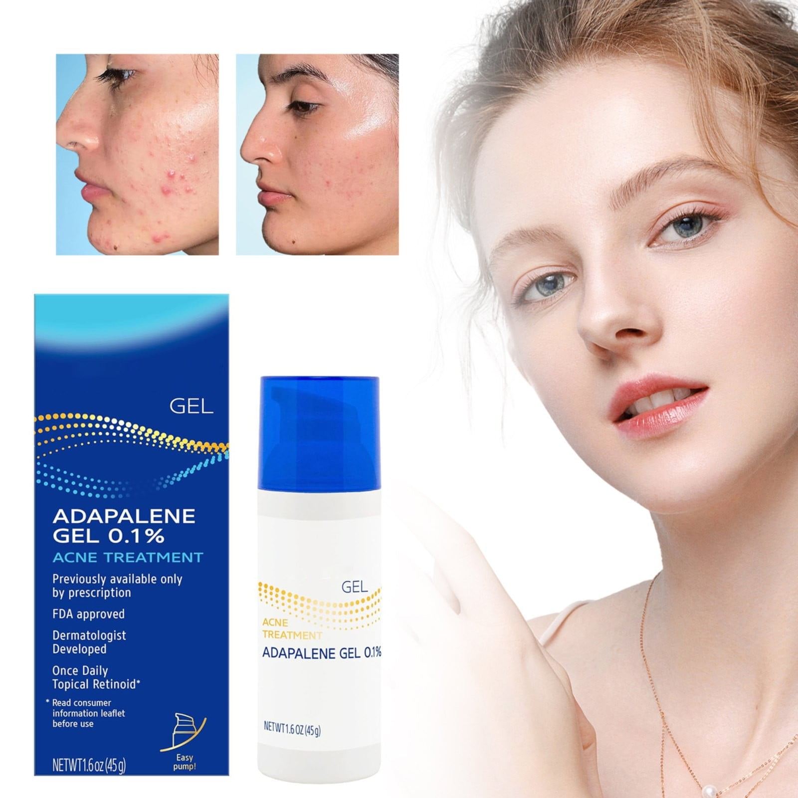 Spring Savings Clearacne Acne Treatment Gel, 30 Day Supply, Retinoid Treatment for Face with 0.1 ...