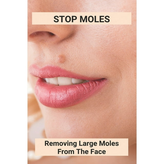 Stop Moles: Removing Large Moles From The Face: Surefire Way To Get Rid ...