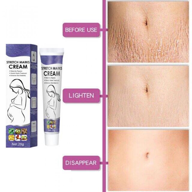 Stretch Marks Permanent Removal Cream Eliminate Body Belly Stretch