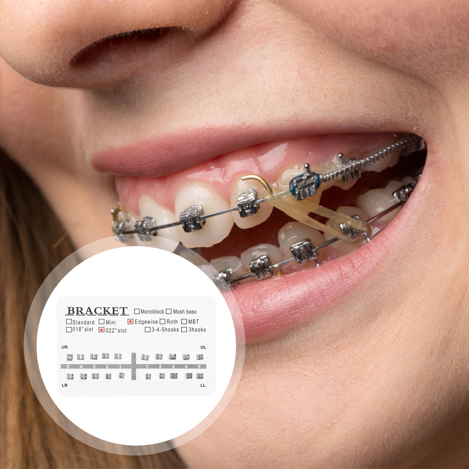 Sturdy Stainless Steel Brace Bracket Oral Brace Bracket Teeth Brace ...