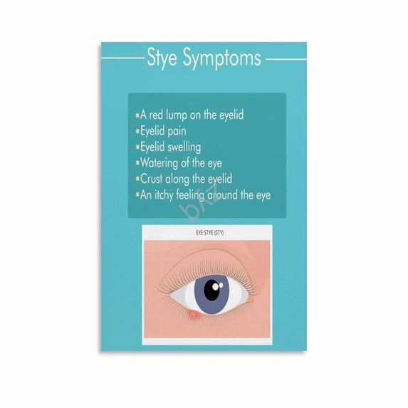 Stye (Hordeolum) Educational Poster Causes And Treatment Clinics (5 ...