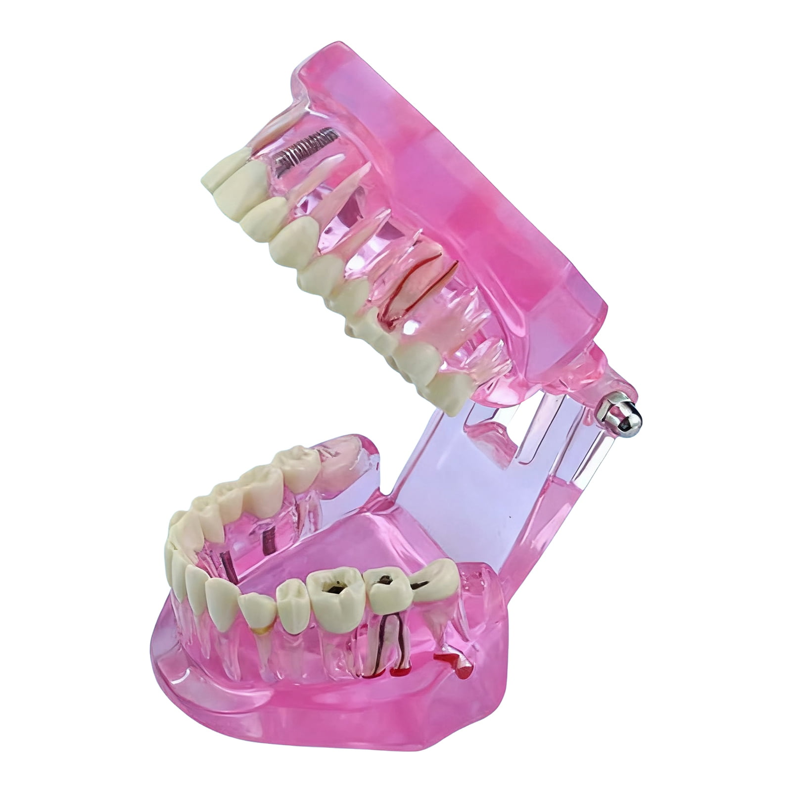 Sylvtty Dental Implant Model Teaching Aid for Dentist Student School ...