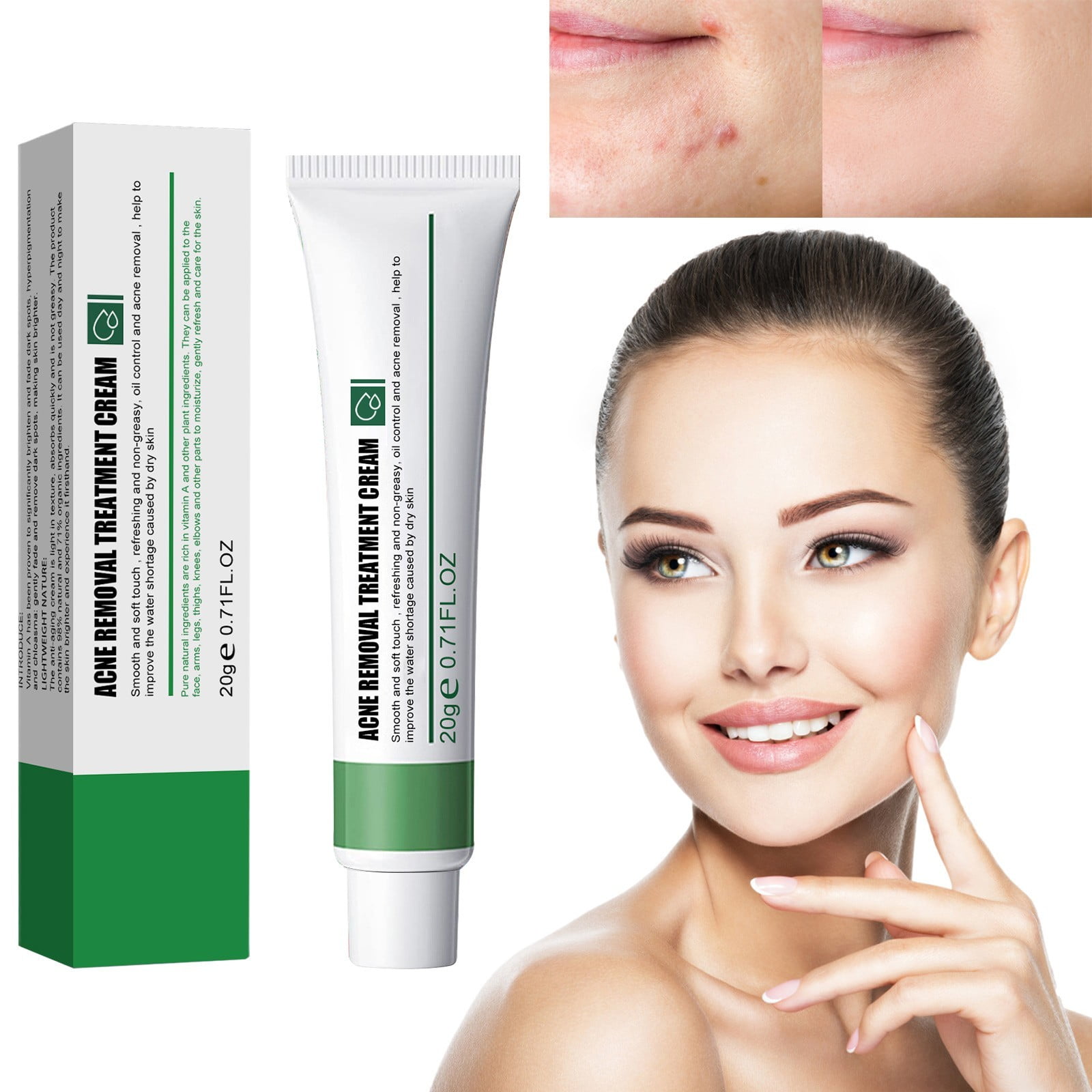 TWCTUWEN Acne Scar Removal Anti Moisturizing Anti Effective Remove ...