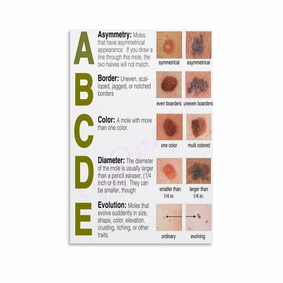 TYPES OF SKIN CANCER ABCDE poster Skin Hospital Wall Decoration Posters ...