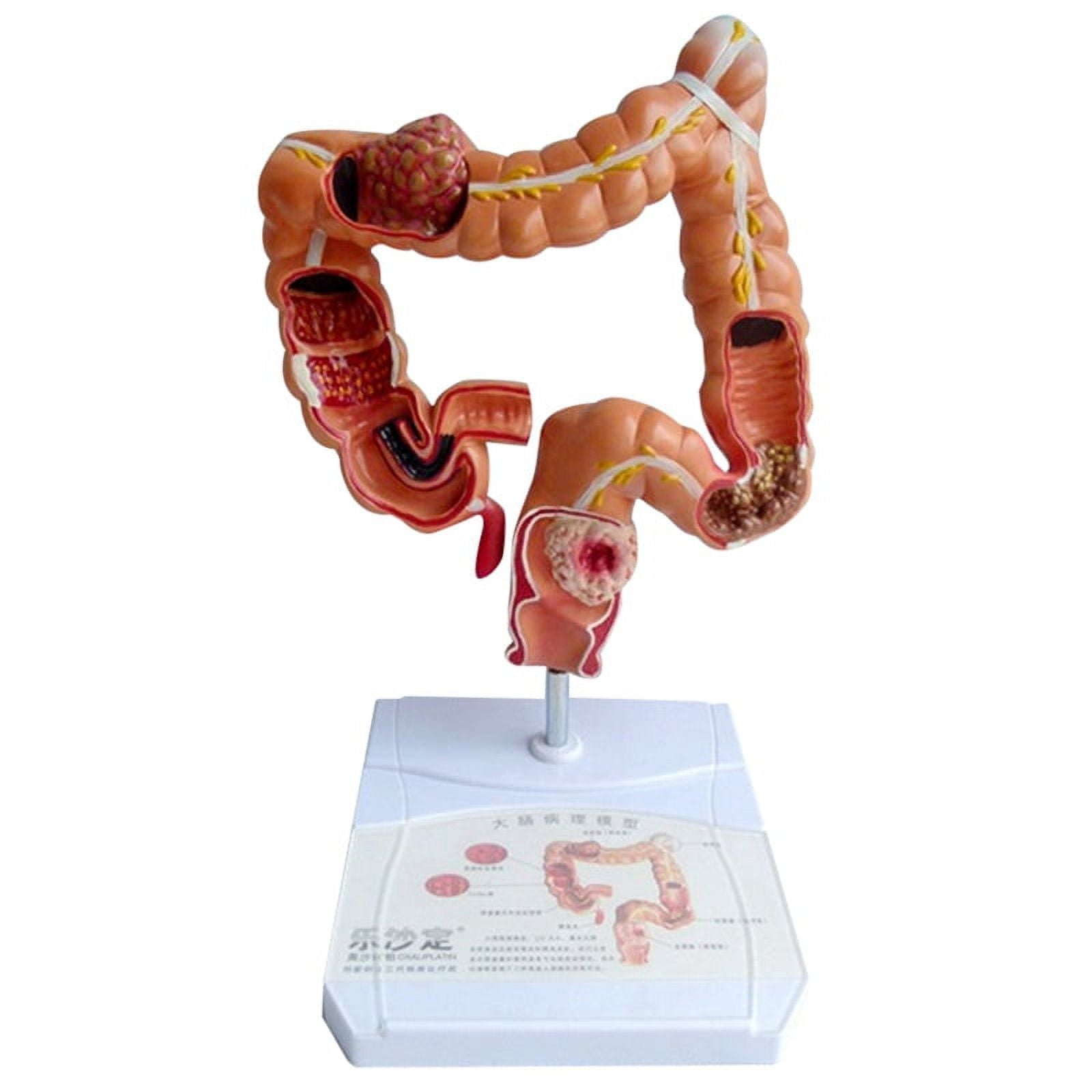 Teaching Model,Human Large Intestine Anatomy Model Visceral Lesion ...