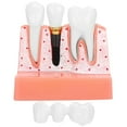 Dental 4 Times Implant Teeth Model Analysis Crown Bridge Demonstration