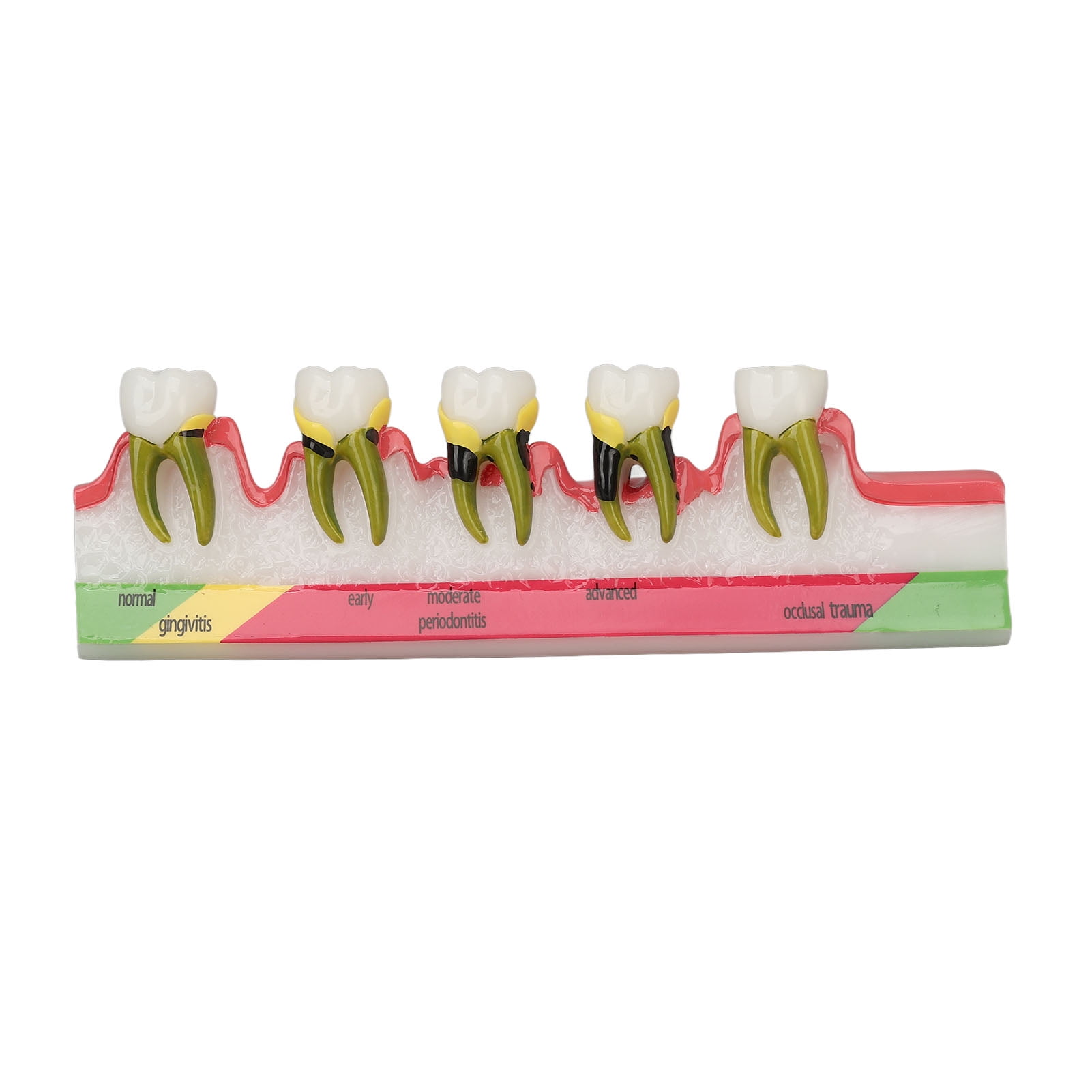 Teeth Periodontal Disease Model Different Stages Resin Dental ...