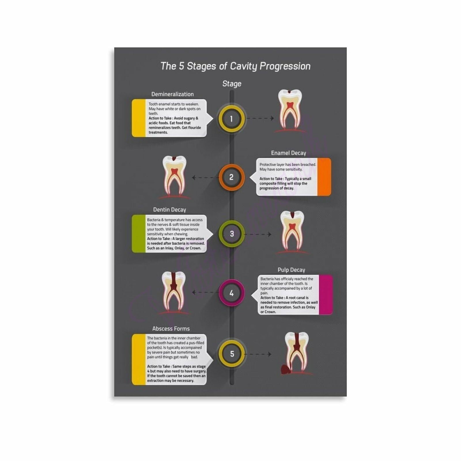The 5 Stages of Cavity Progression Oral Health Literacy Poster Canvas ...